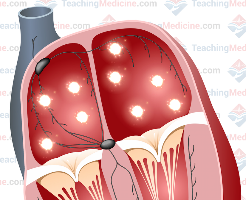 multiple atrial re-entry circuits multiple atrial re-entry circuits